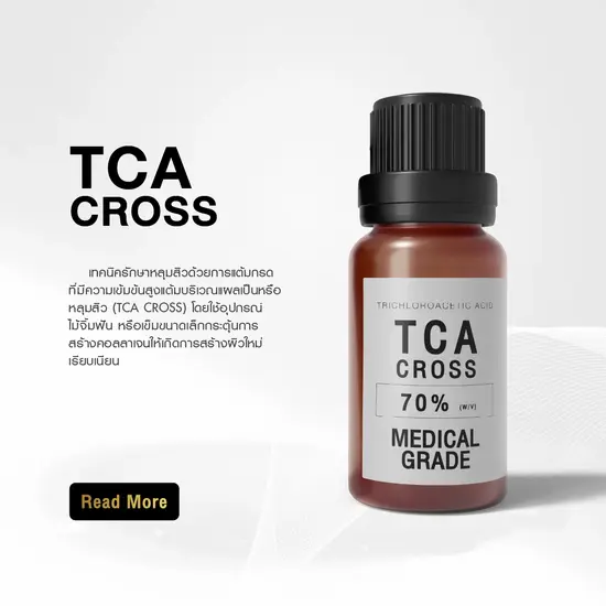 การรักษาหลุมสิวด้วย TCA Cross กระตุ้นการสร้างคอลลาเจน
